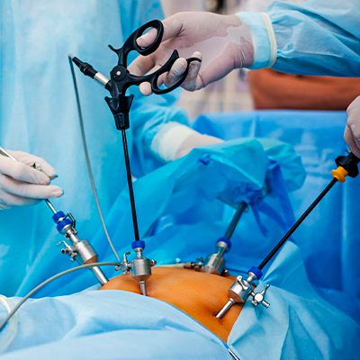 Cirurgia para câncer de intestino: como funciona? - Clínica Hepatogastro