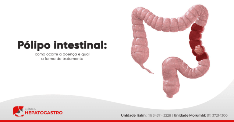 Pólipo Intestinal: Como Ocorre A Doença E Qual A Forma De Tratamento ...
