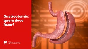 Gastrectomia: Quem Deve Fazer? - Clínica Hepatogastro