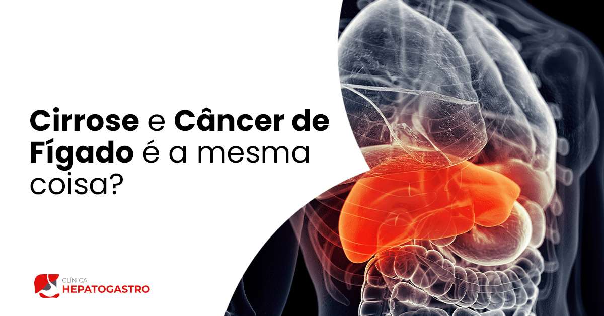 Cirrose E Câncer De Fígado São A Mesma Coisa? - Clínica Hepatogastro