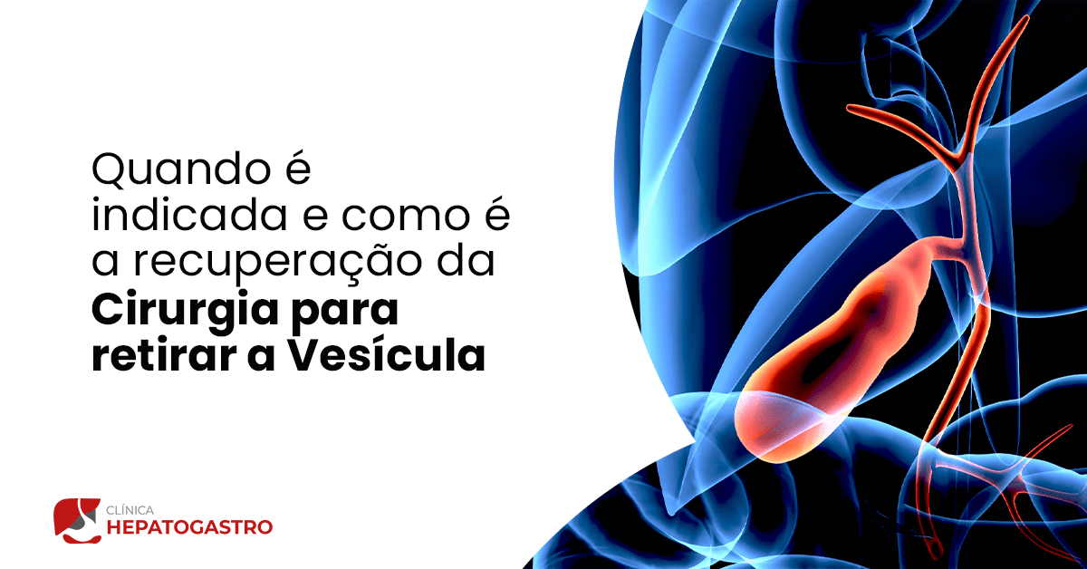 Quando é Indicada E Como é A Recuperação Da Cirurgia Para Retirar A ...