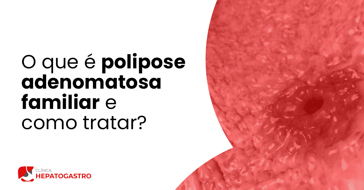 Polipose Adenomatosa Familiar Familial Adenomatous Polyposis Drawing