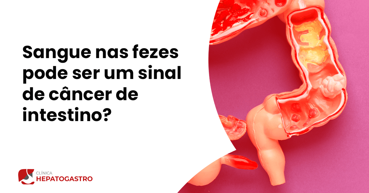 Sangue Nas Fezes Pode Ser Um Sinal De Câncer De Intestino? - Clínica ...